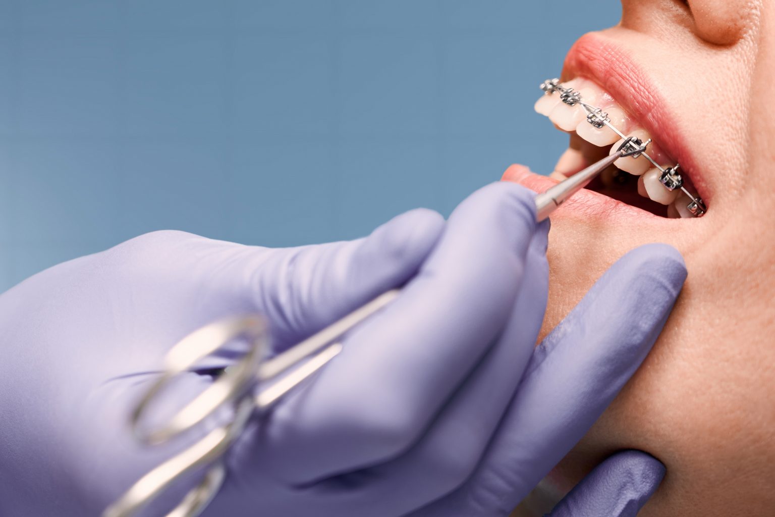 Tipos de brackets: Conoce los diferentes para tu ortodoncia